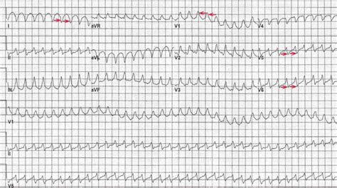 Ecg Case 183 Atrial Flutter With 1 1 Conduction Manual Of Medicine