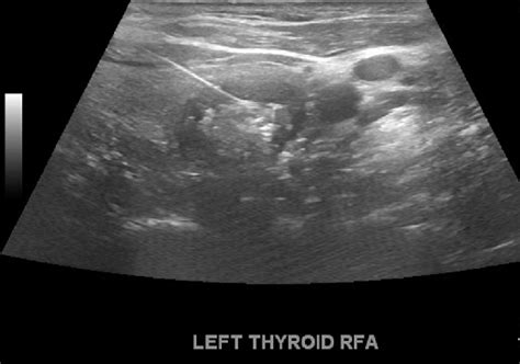 Ultrasound Guided Radiofrequency Ablation Of A Toxic Nodule Rfa