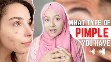 What Is Your Pimple Type YouTube