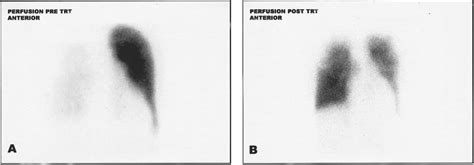 Technetium Tc 99m Lung Perfusion Scan In Anterior Projection A Download Scientific Diagram