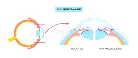 Glaucoma Ilustración Del Vector Ilustración De Visual 325082404