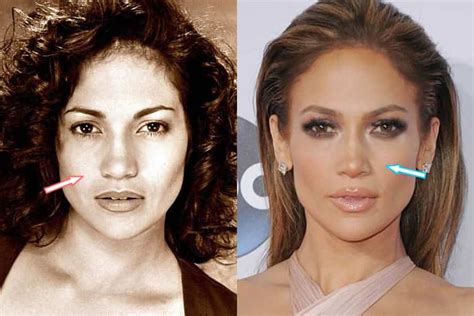 Has Jennifer Lopez Had Cosmetic Surgery Before And After 2018