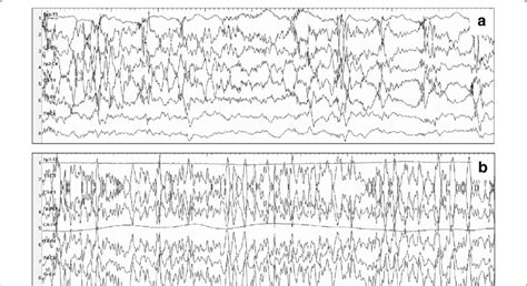 Exemplary Sections Of Electroencephalograms Eeg Of Two Patients With