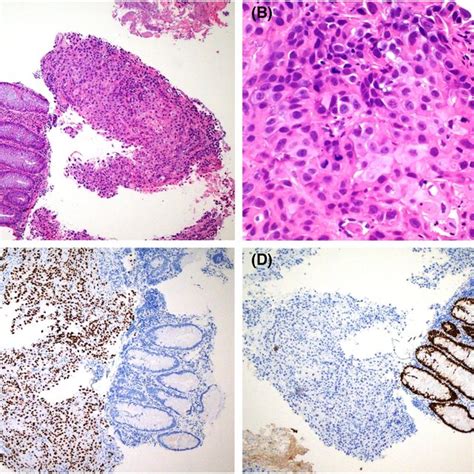 A The Colonic Mucosa Is Intact Left Side Of The Field The