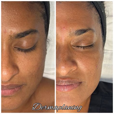 Dermaplaning Sewell Nj