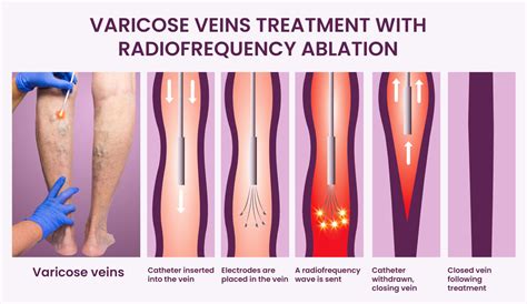 Radiofrequency Ablation The Vein Institute Of Hunterdon