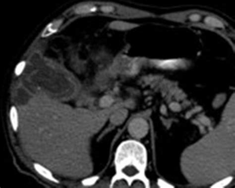 Liver Atlas Diagnosis Abscess Pericholecystic