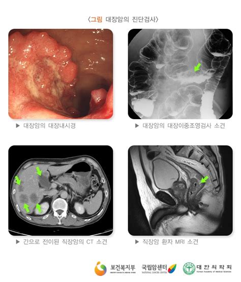 대장내시경으로 채취한 대장암 조직검사 사진 네이버 블로그