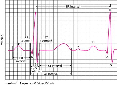长 Qt 间期综合征 长 Qt 间期综合征 《默沙东诊疗手册大众版》