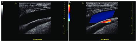 Left Upper Arm Deep Venous Doppler Us In A 62 Year Old Man A Lower Download Scientific