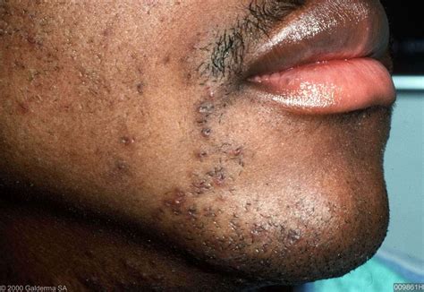 Pseudofolliculitis Barbae