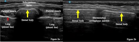 A Case Of Pediatric Sternal Fracture Diagnosed By Pocus Pocus Journal