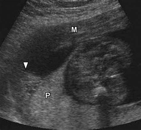 Imaging Of The Placenta A Multimodality Pictorial Review Radiographics