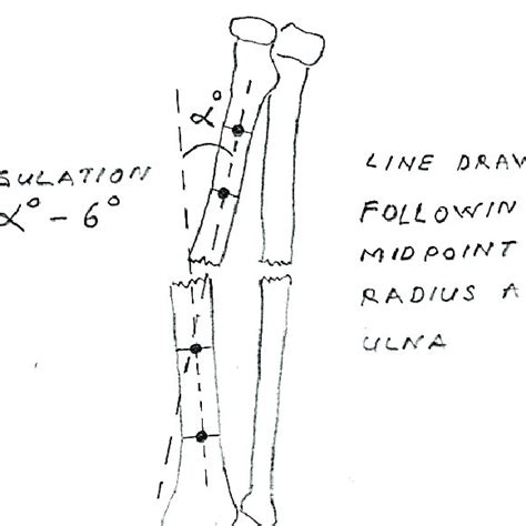 An Illustration Showing The Division Of Forearm Into 5 Regions And Only