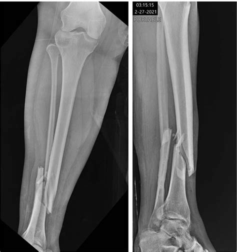 Initial Radiographs Demonstrating Fractures Of The Proximal Fibular Download Scientific Diagram