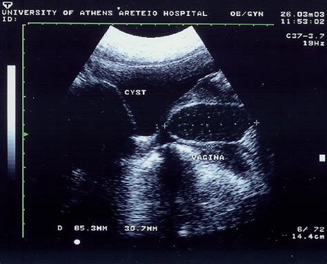 Expert Opinion Vaginal Aplasia Creation Of A Neovagina Following The