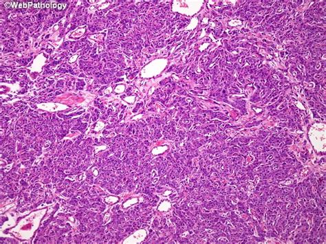 Pheochromocytoma Features Of Malignancy
