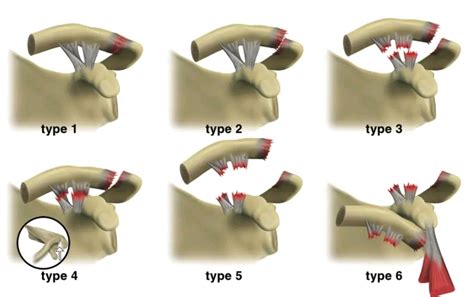 Georgios Kakavas On Linkedin Acromioclavicular Joint Injuries And More Specifically