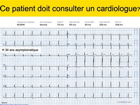 Orage Rythmique E Cardiogram