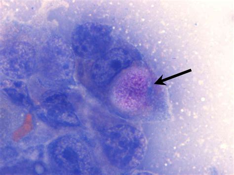 Transitional Cell Carcinoma Tcc In A Dog Case Study Cytopath