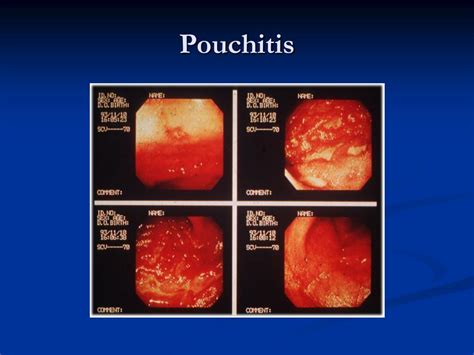 Ppt The Management Of Pouchitis And Cuffitis Powerpoint Presentation Id2946061