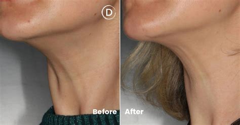 Transform Your Neck The Magic Of Botox For Platysma Bands