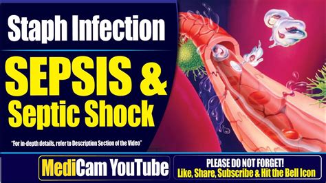 Can Staph Infection Become Sepsis