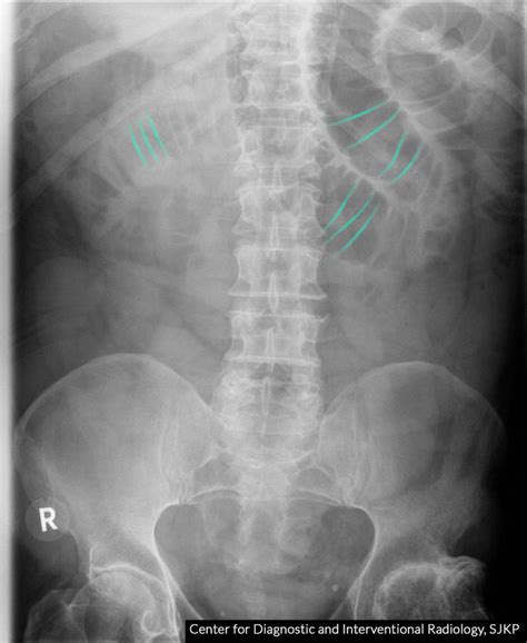 Paralytic Ileus
