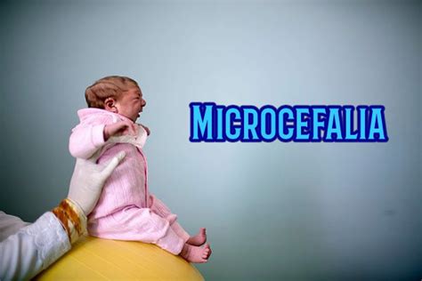 ¿qué Es La Microcefalia Clinica Medica Porter