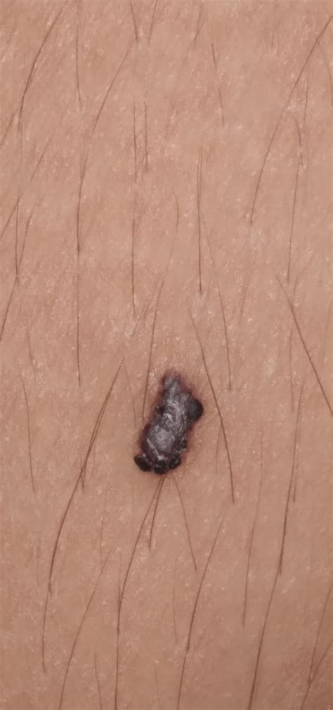 This Lesion On The Scalp Has Been Growing For The Past 4 Weeks In The