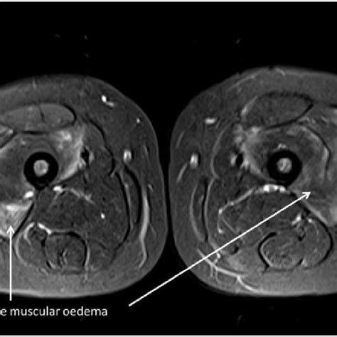 Axial Stir Mri Sequence Of Both Thighs Moderate Increased Signal Is Download Scientific