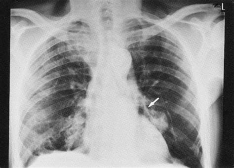 Rounded Pulmonary Atelectasis Eurorad