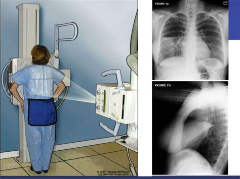 Chest X Ray Cpt At Amy Beasley Blog