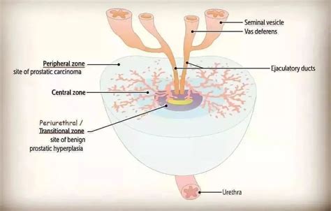 Latest Medical News Prostate Cancer Affects The Peripheral Zone I E Easily Examined By Dre