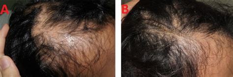 Right Half Of The Scalp PRP And TrA A Before Treatment B After Download Scientific