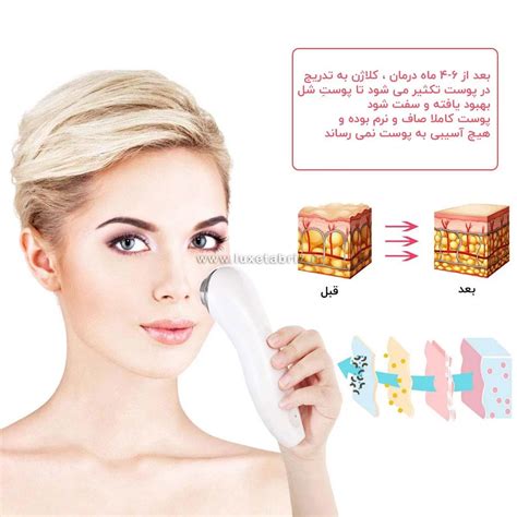 خرید دستگاه مینی هایفو کلین Mh 5 لوکس تبریز