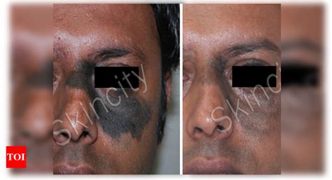 A Revolutionary Technology To Remove Birthmarks Times Of India