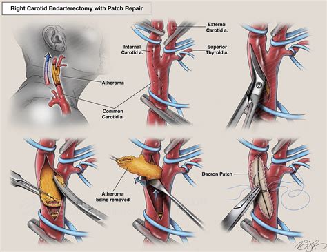 Endarterectomy Carotid