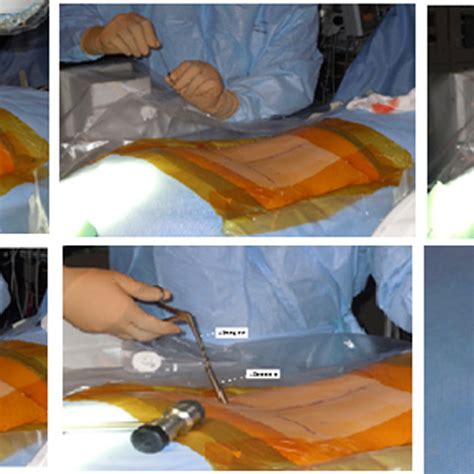 Pdf Endoscopic Transforaminal Decompression Interbody Fusion And