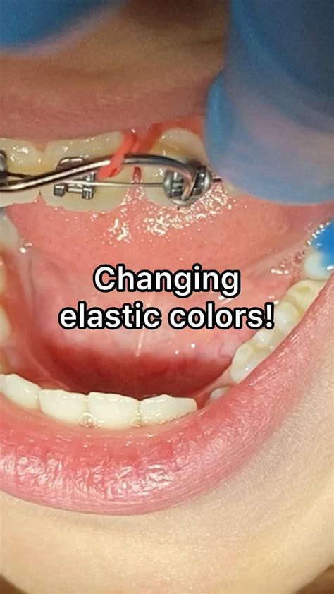 Braces Time Artofit Braces Time Artofit