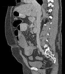 Ischemic Bowel With Subtle Clot In Distal Sma Small Bowel Radiology