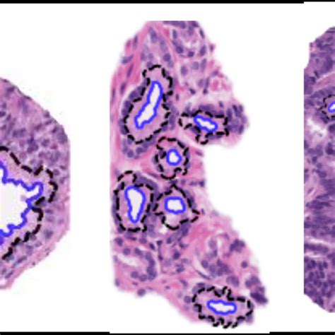 2 Results Of The Automatic Segmentation Algorithm Blue Contours Lumen