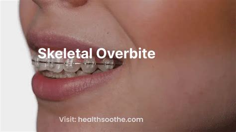 Understanding Skeletal Overbite