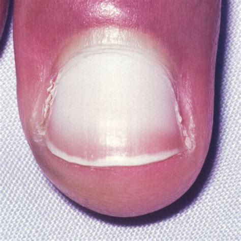 Nail Abnormalities Common Types Causes And Prevention