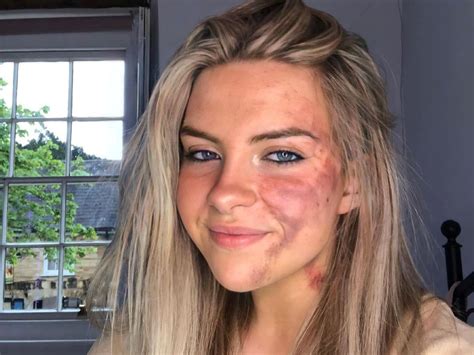 Woman With Mystery Rash On Her Face Says Doctors Cant