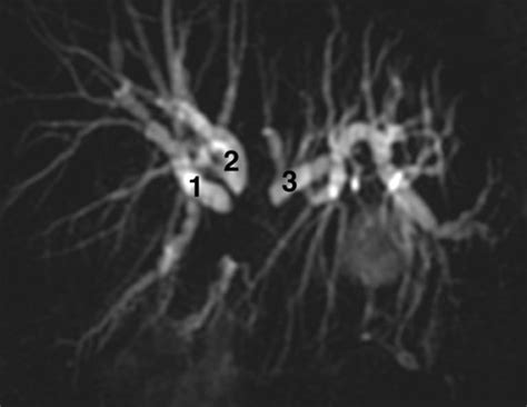 Bismuth Type Iiia Hilar Stricture The Main Hepatic Confluence And The Download Scientific
