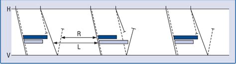 Figure 1 From Alternating Bundle Branch Block During Atrial Bigeminy Semantic Scholar