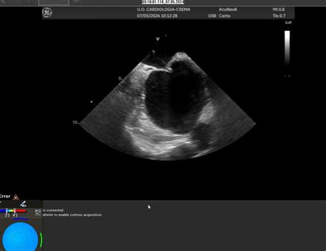 Pulmonary Veins Isolation With Carto 3 System In Patients With