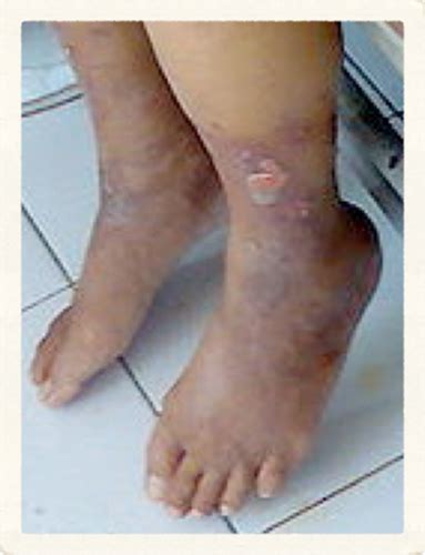 week 9 lecture 1 understanding vascular disease in medicine flashcards