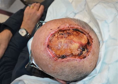 Plastic And Reconstructive Surgery Global Open